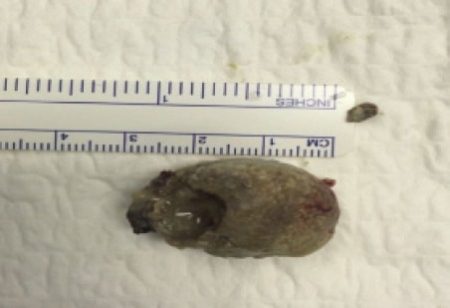 Mandelsteine - HNO Praxis Dr. Weinzierl